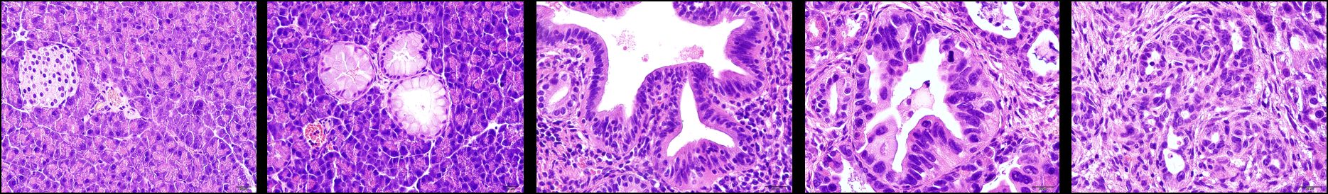 Pancreas Cancer